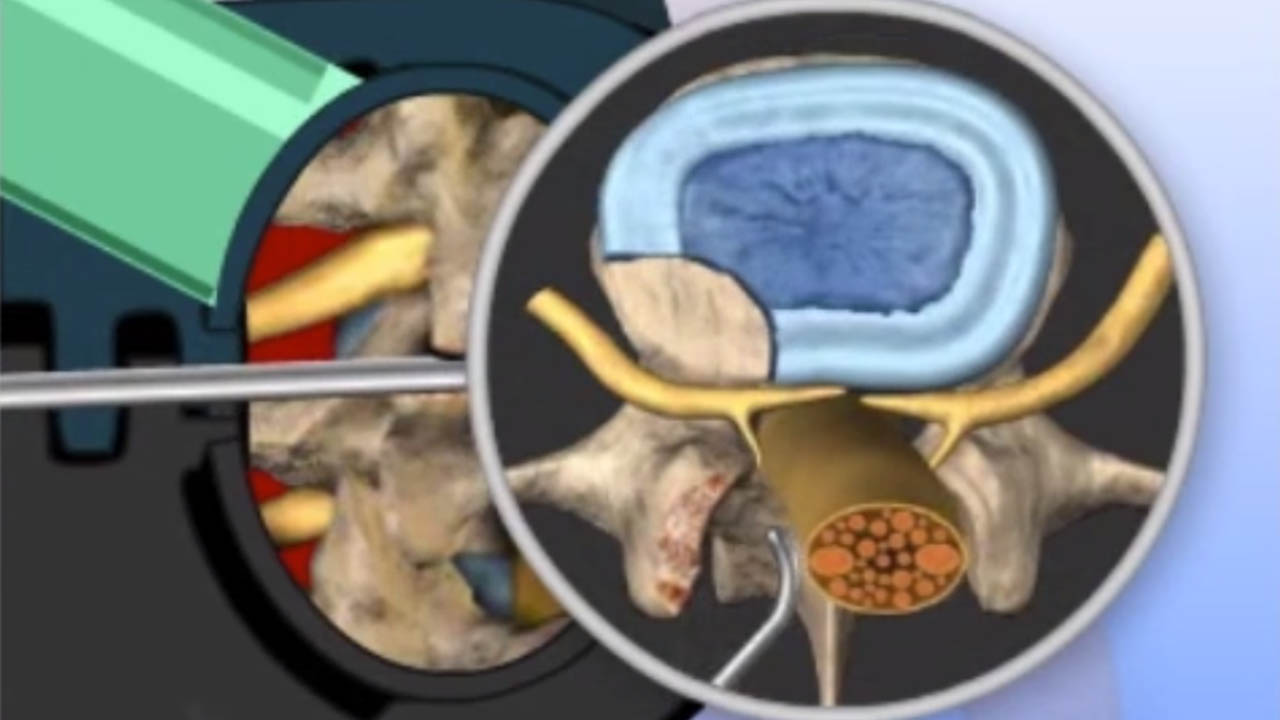 Microdiscectomy Recovery