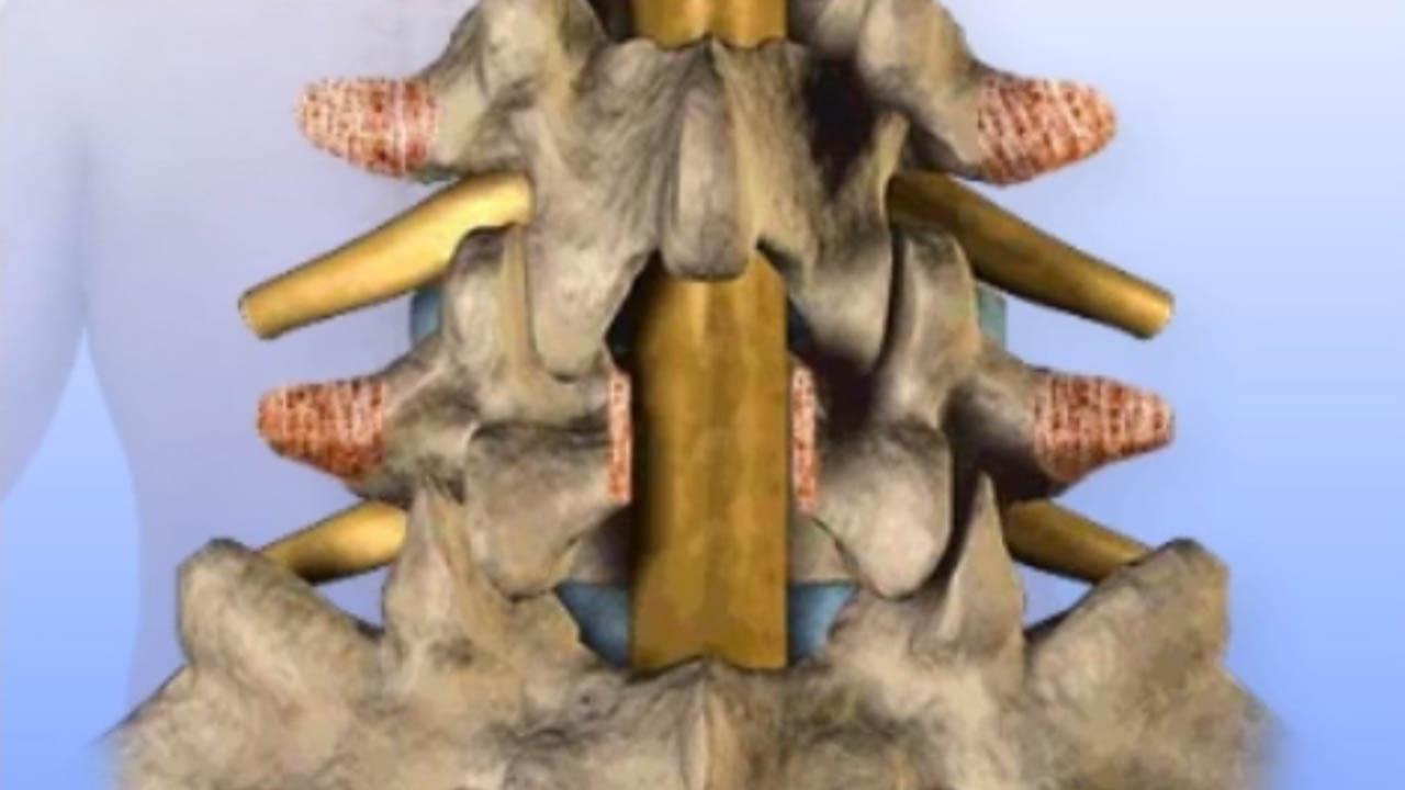 Thoracic Laminectomy